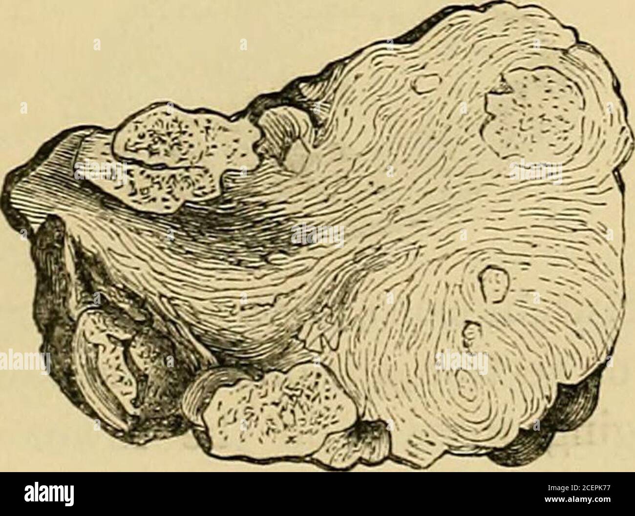 Fibrous epulis hi-res stock photography and images - Alamy