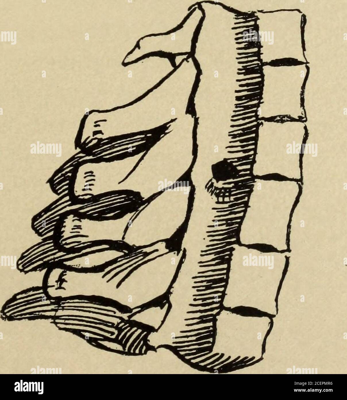 Laminectomy hi-res stock photography and images - Alamy