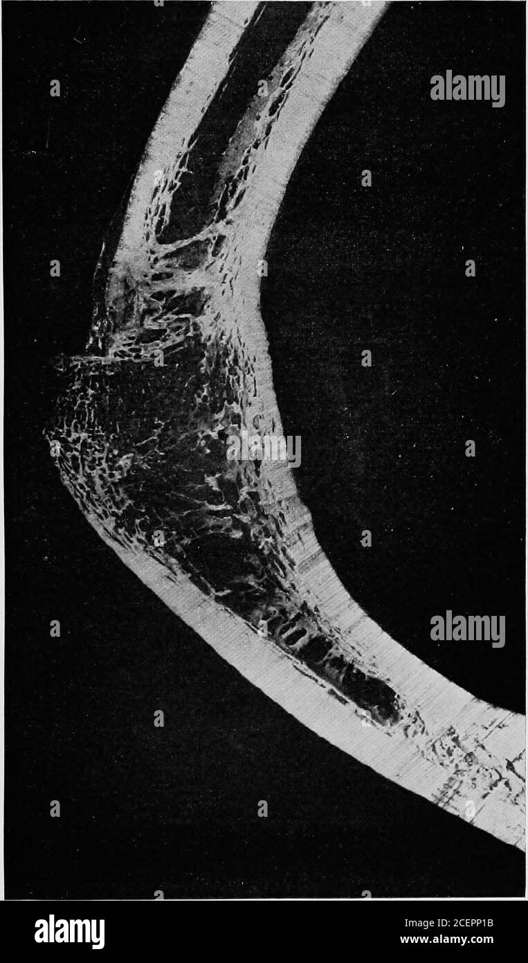 Trabeculae bone femur hi-res stock photography and images - Alamy