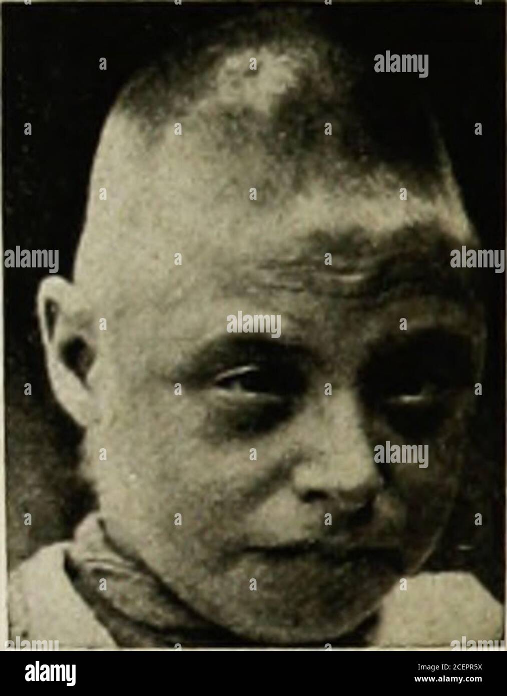 Microcephalic hi-res stock photography and images - Alamy