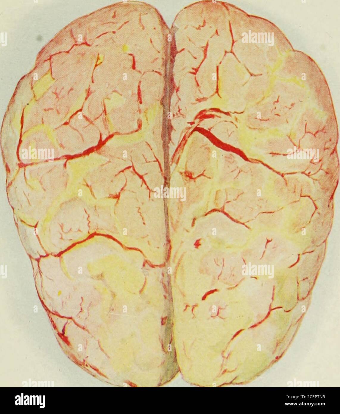 Pus brain hi-res stock photography and images - Alamy