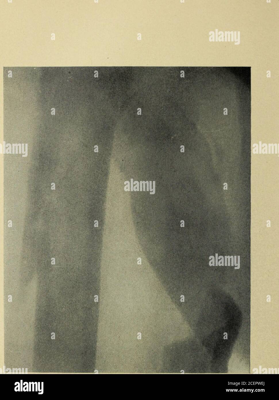 Fracture Forehead High Resolution Stock Photography and Images - Alamy