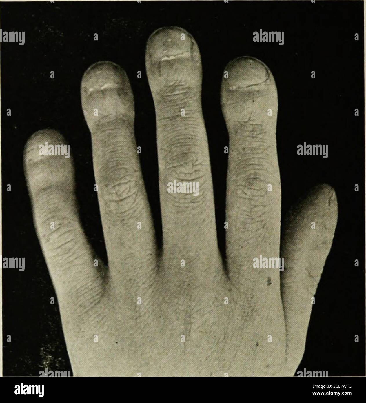 Clubbed fingers hi-res stock photography and images - Alamy