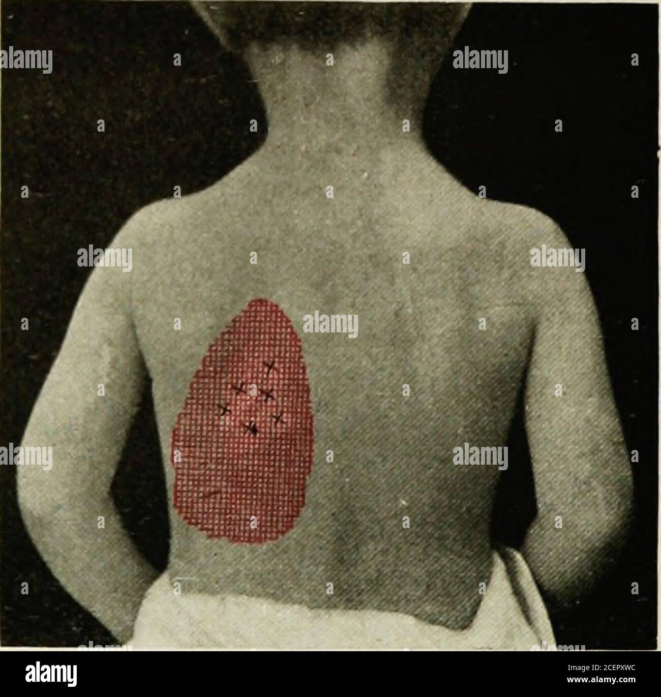 . The diseases of infancy and childhood. Fig. 68.—First Stage ...