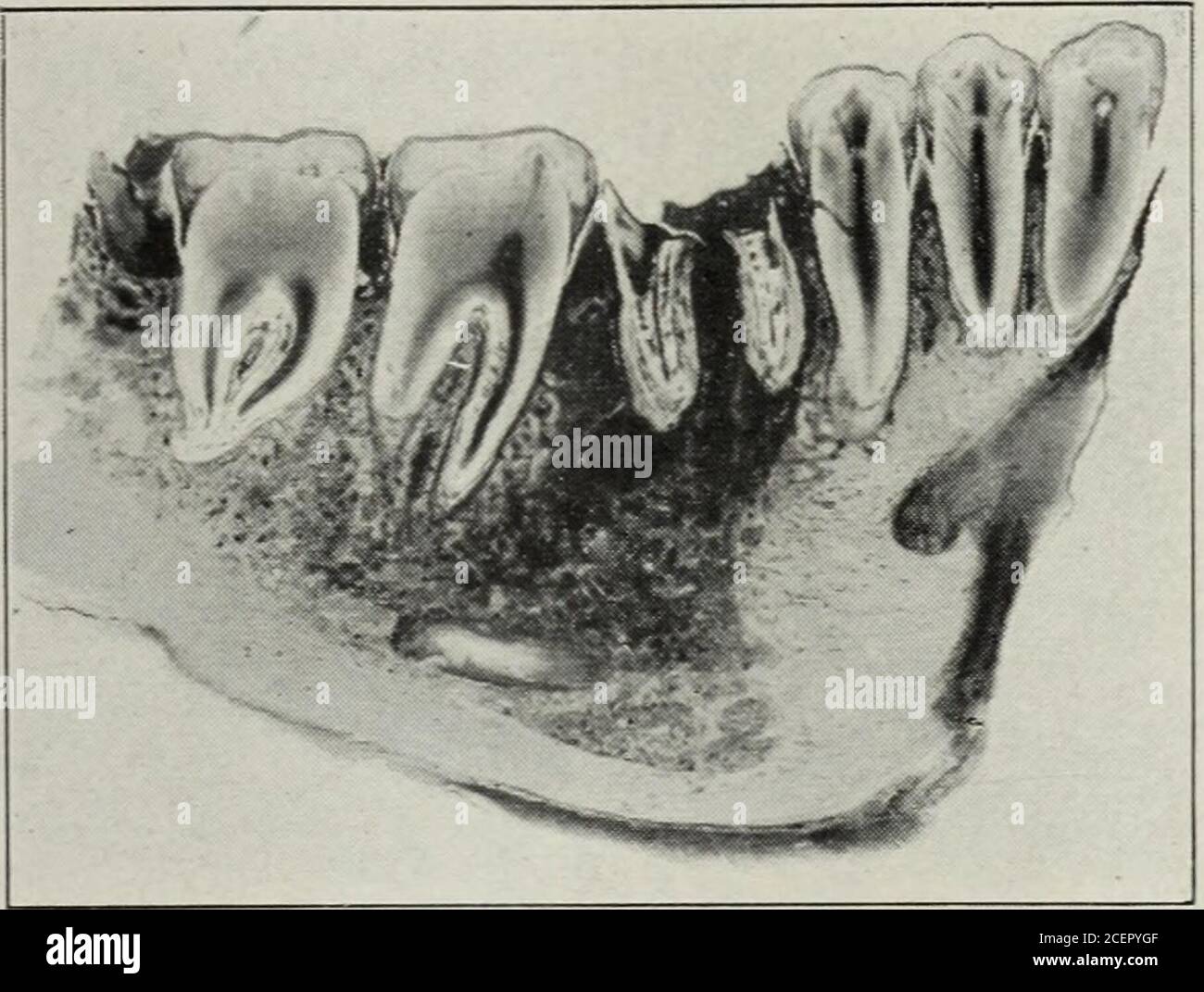 Cortical Bone Teeth