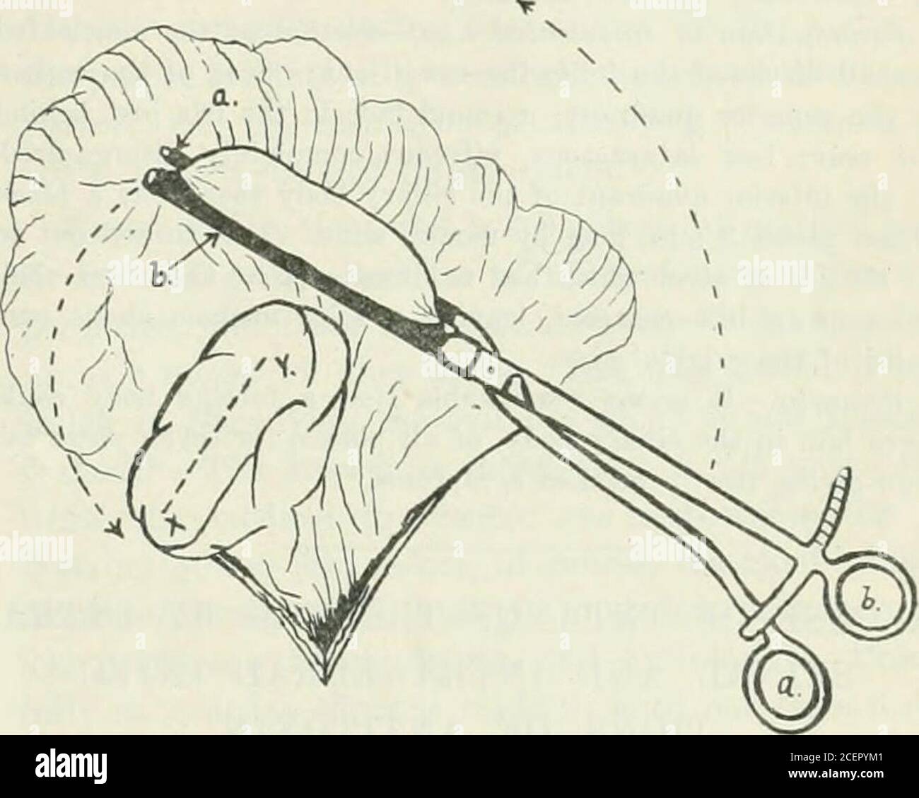 Y Incision High Resolution Stock Photography and Images - Alamy