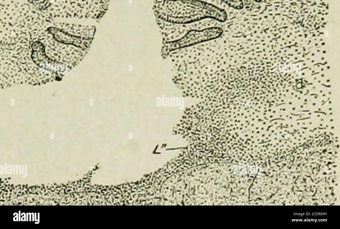 Severe acute colitis hi-res stock photography and images - Alamy