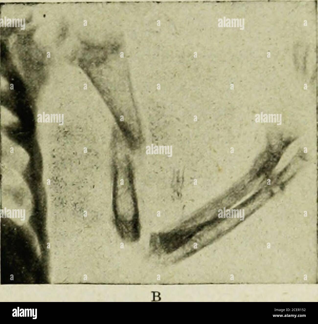 Rickets leg hi-res stock photography and images - Alamy