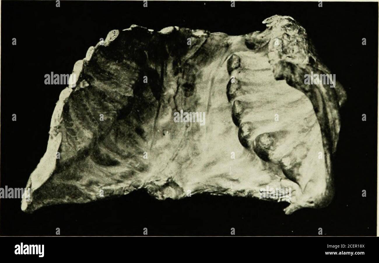 . The diseases of infancy and childhood. Deformity of the Chest in ...