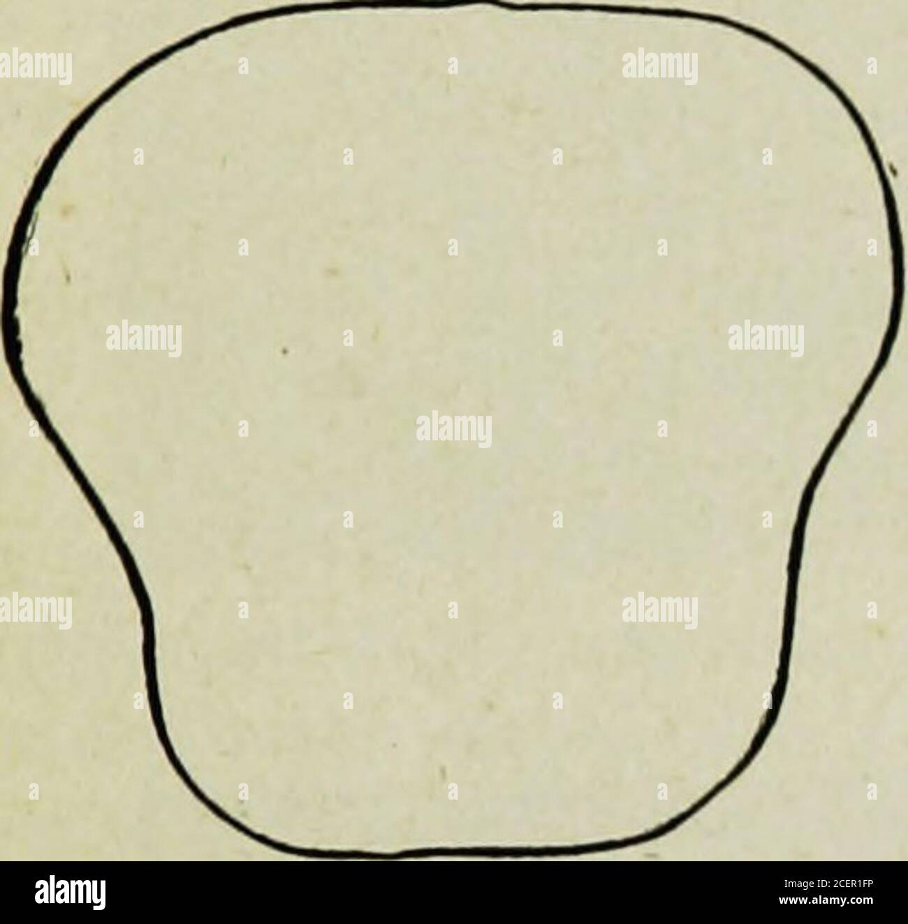 . The diseases of infancy and childhood. Fig. 23.—Rachitic Skull from a ...