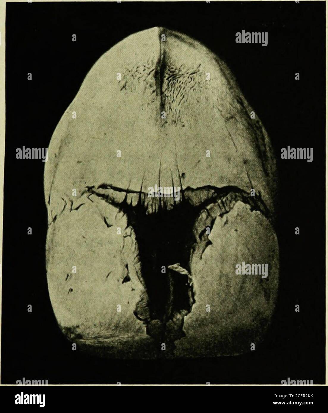 Cretinism High Resolution Stock Photography and Images - Alamy