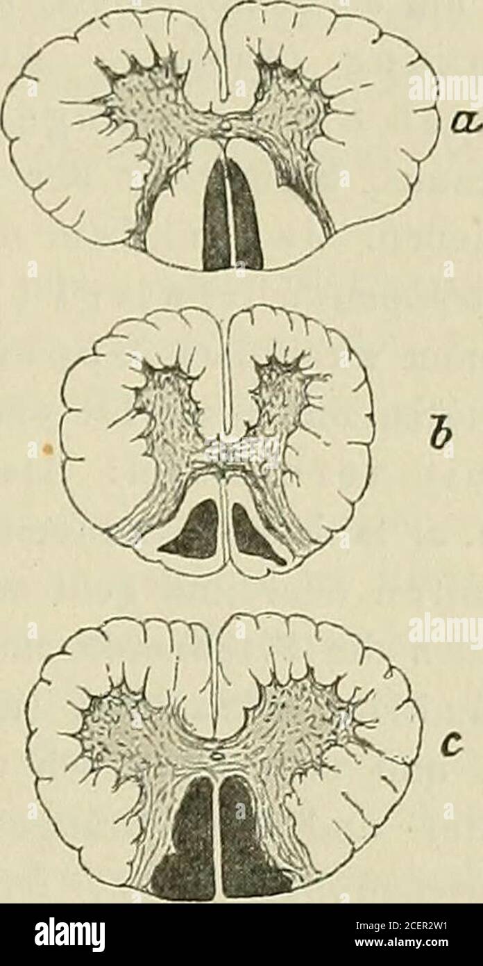 Tabes dorsalis hi-res stock photography and images - Alamy