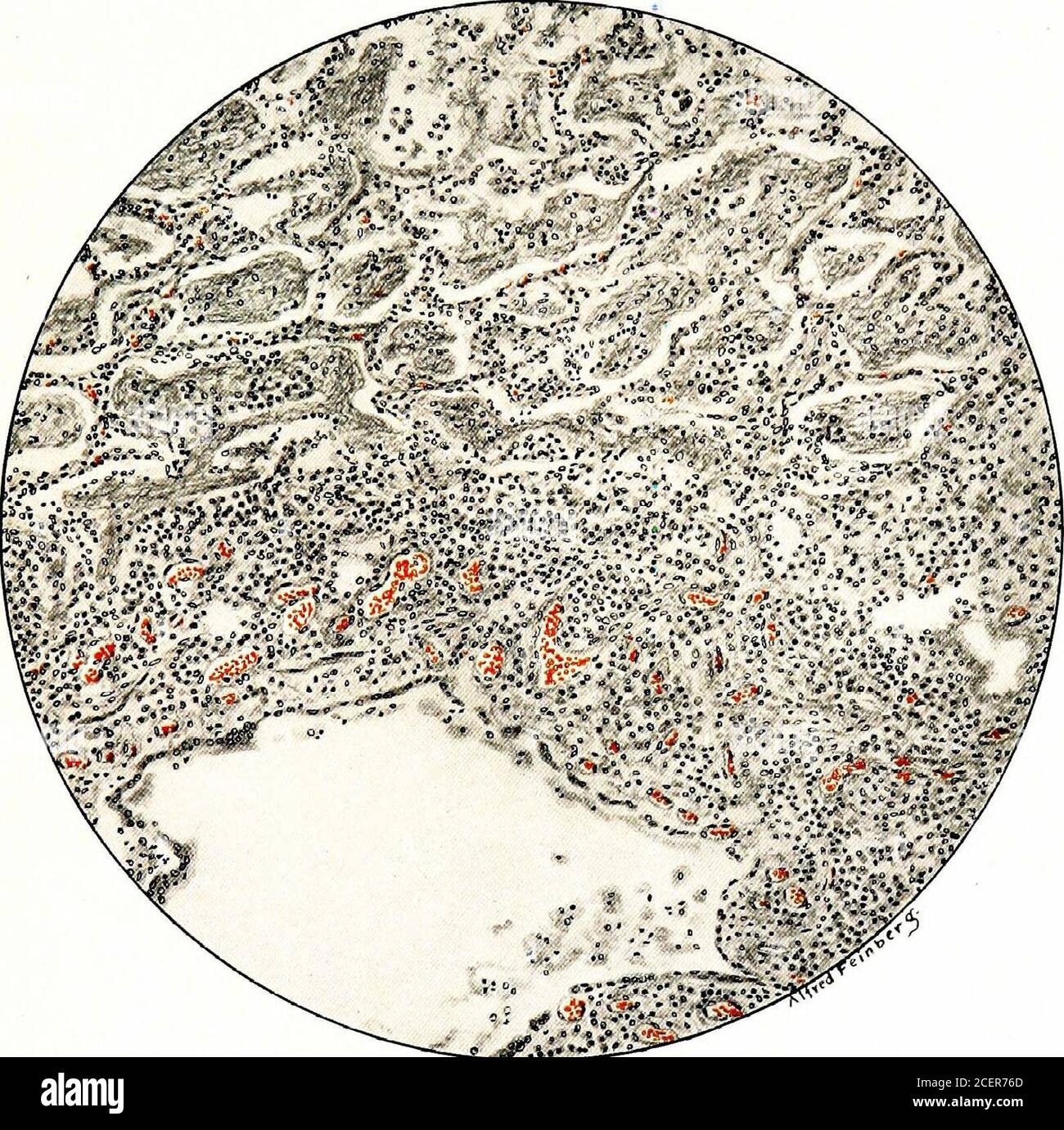. The pathology of the pneumonia in the United States army camps during ...