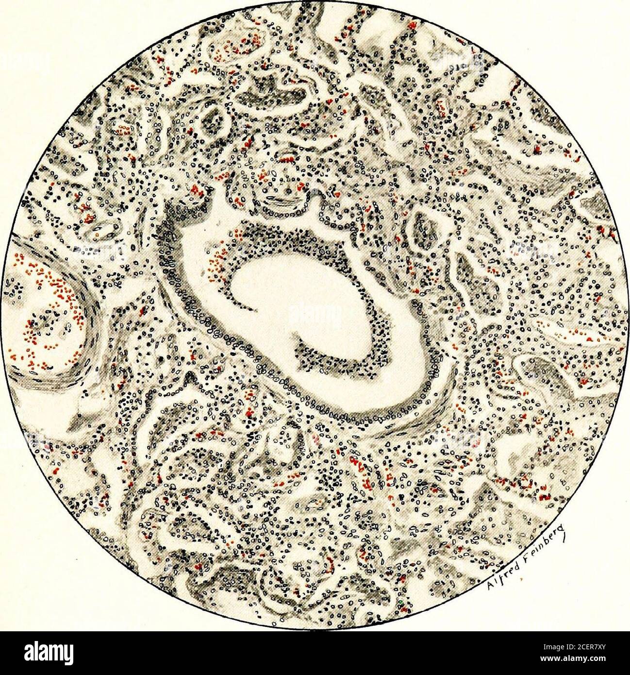 . The pathology of the pneumonia in the United States army camps during ...