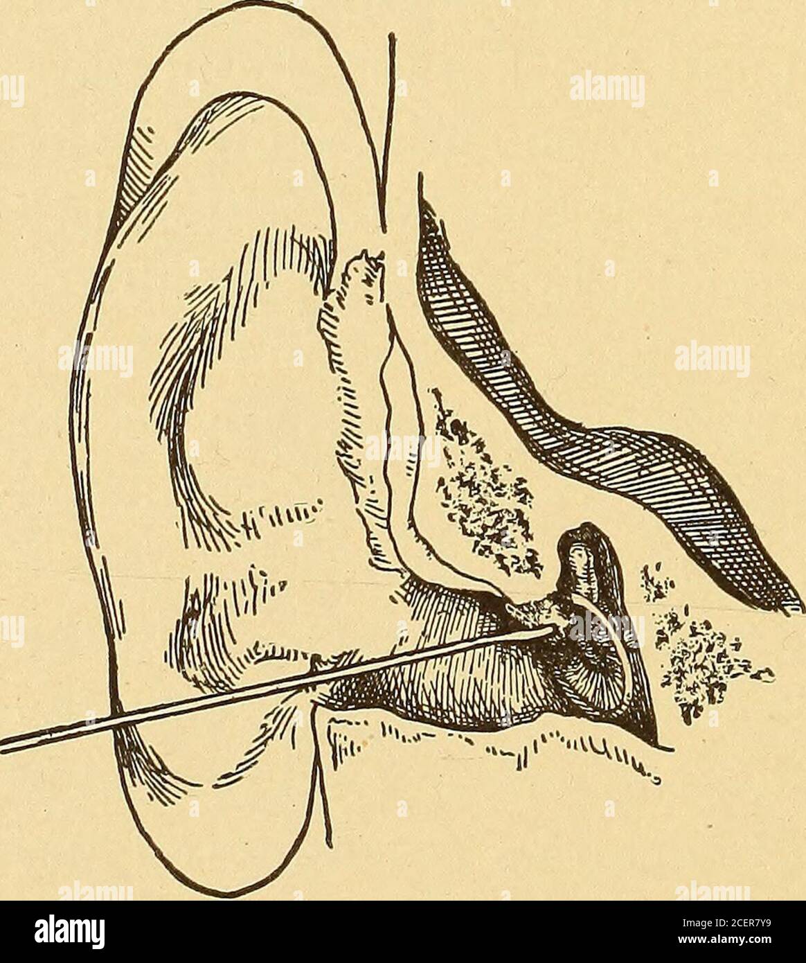 Myringotomy hi-res stock photography and images - Alamy