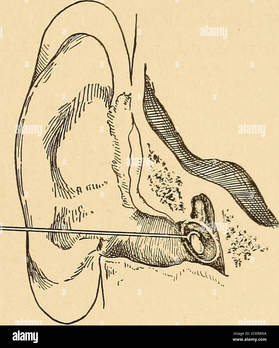 Polyp in the ear hi-res stock photography and images - Alamy