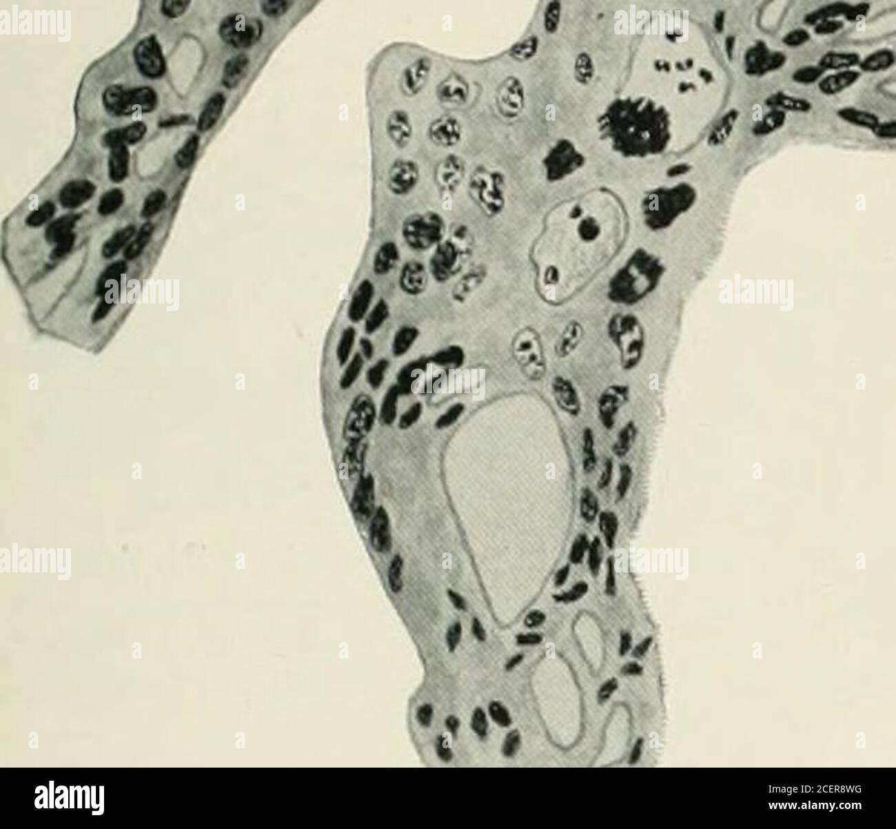 Langhans giant cells hi-res stock photography and images - Alamy