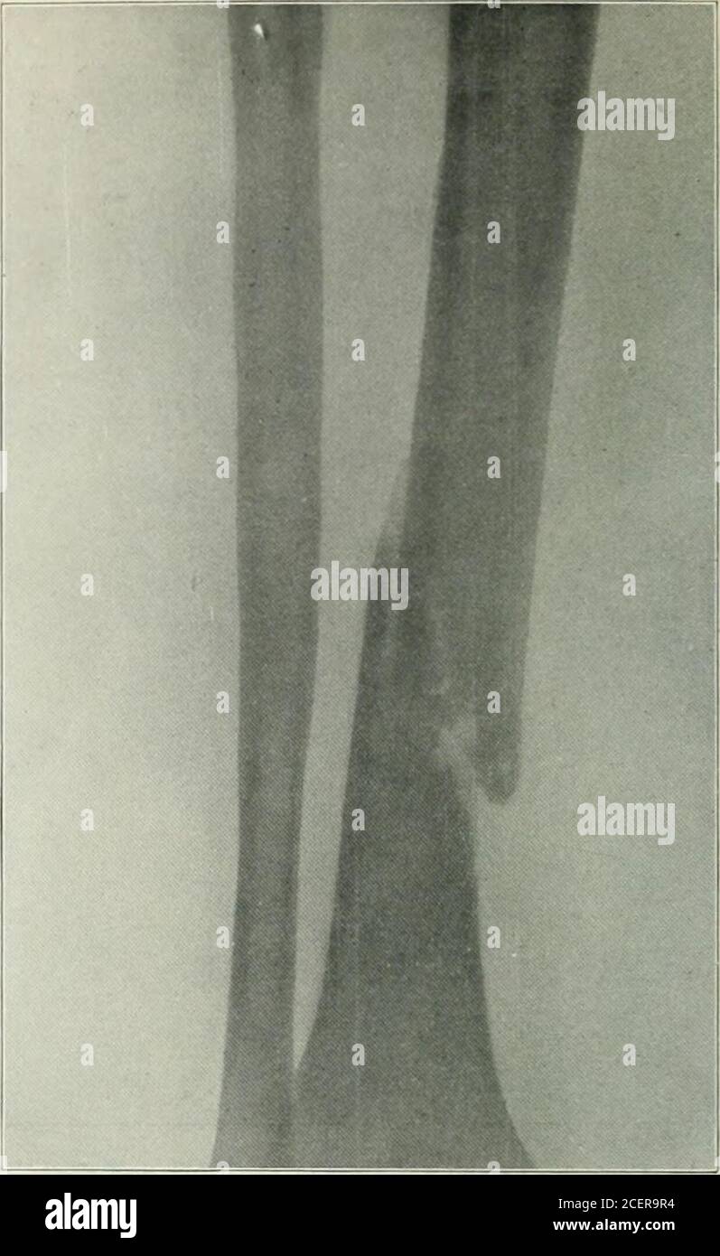 . Journal - American Medical Association. Fig. S.—Insf 3- Closed ...