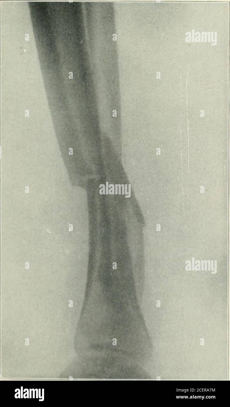 . Journal - American Medical Association. Fig. 1.—Case 2. Closed ...