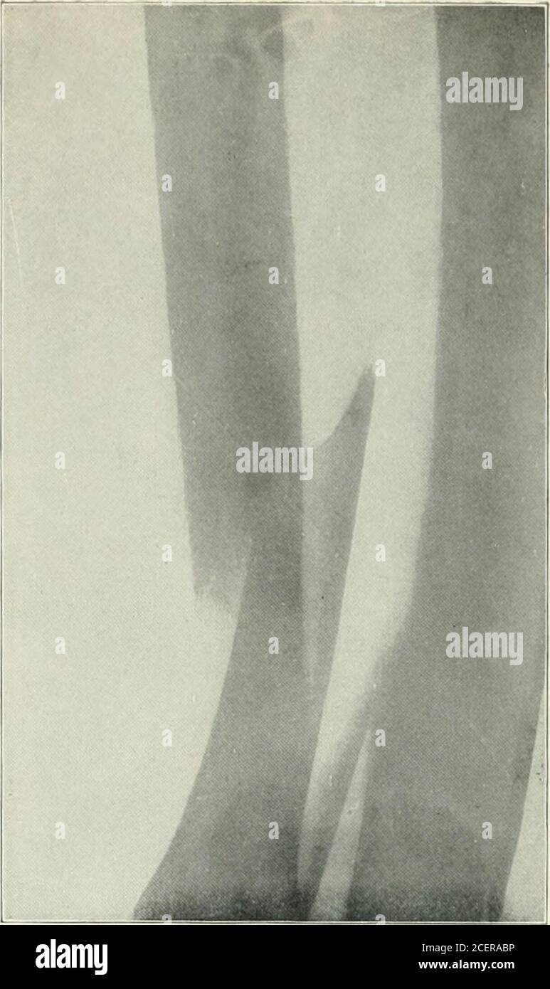 . Journal - American Medical Association. Fig. 1.—Case 2. Closed ...