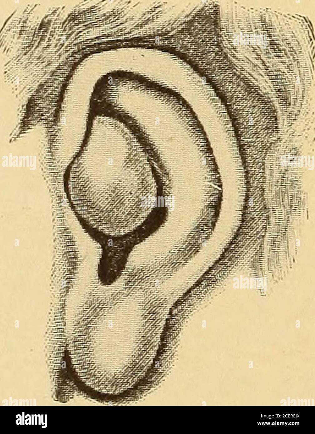Necrotic tissue hi-res stock photography and images - Alamy