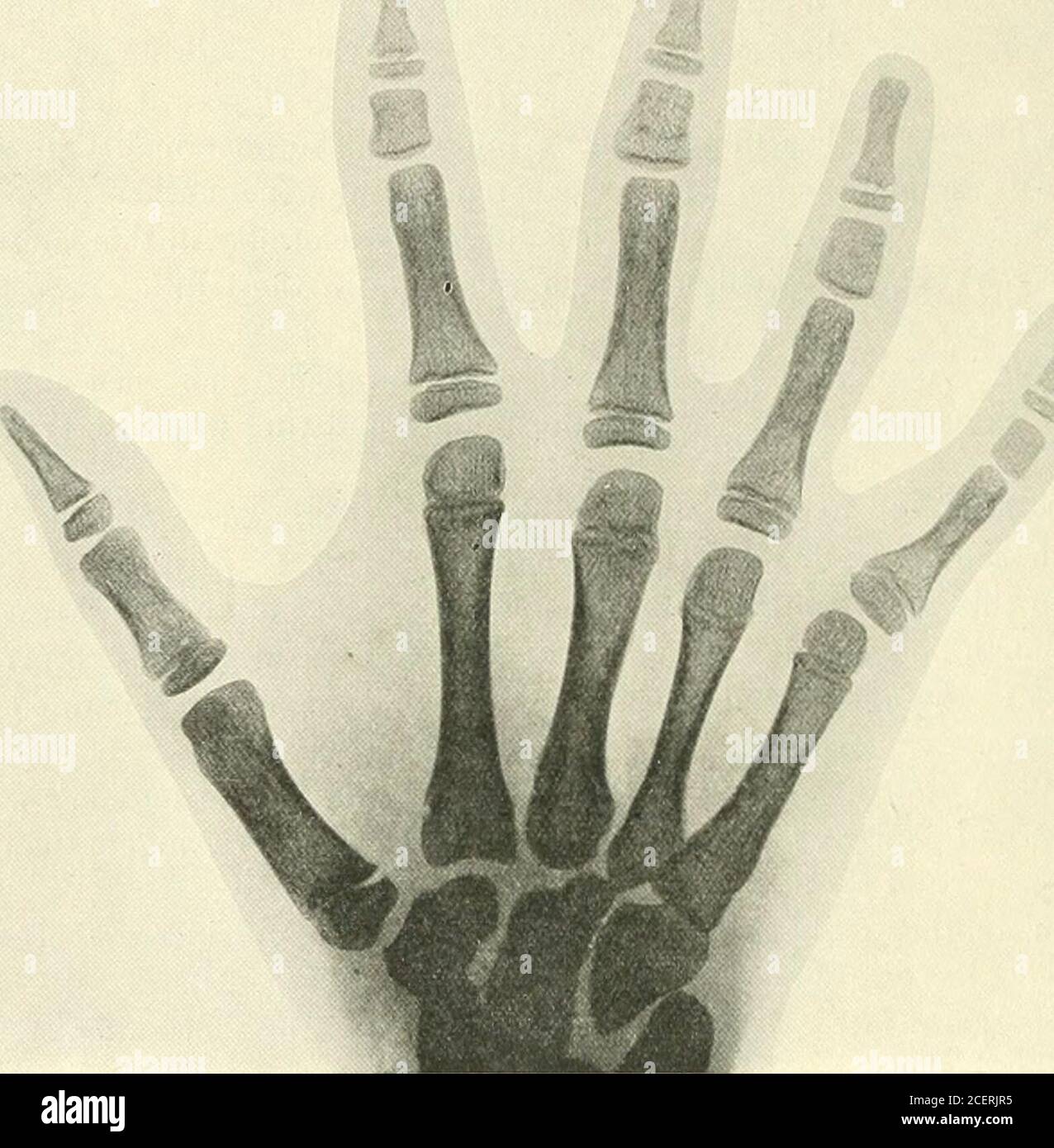 Ankylosis High Resolution Stock Photography and Images - Alamy