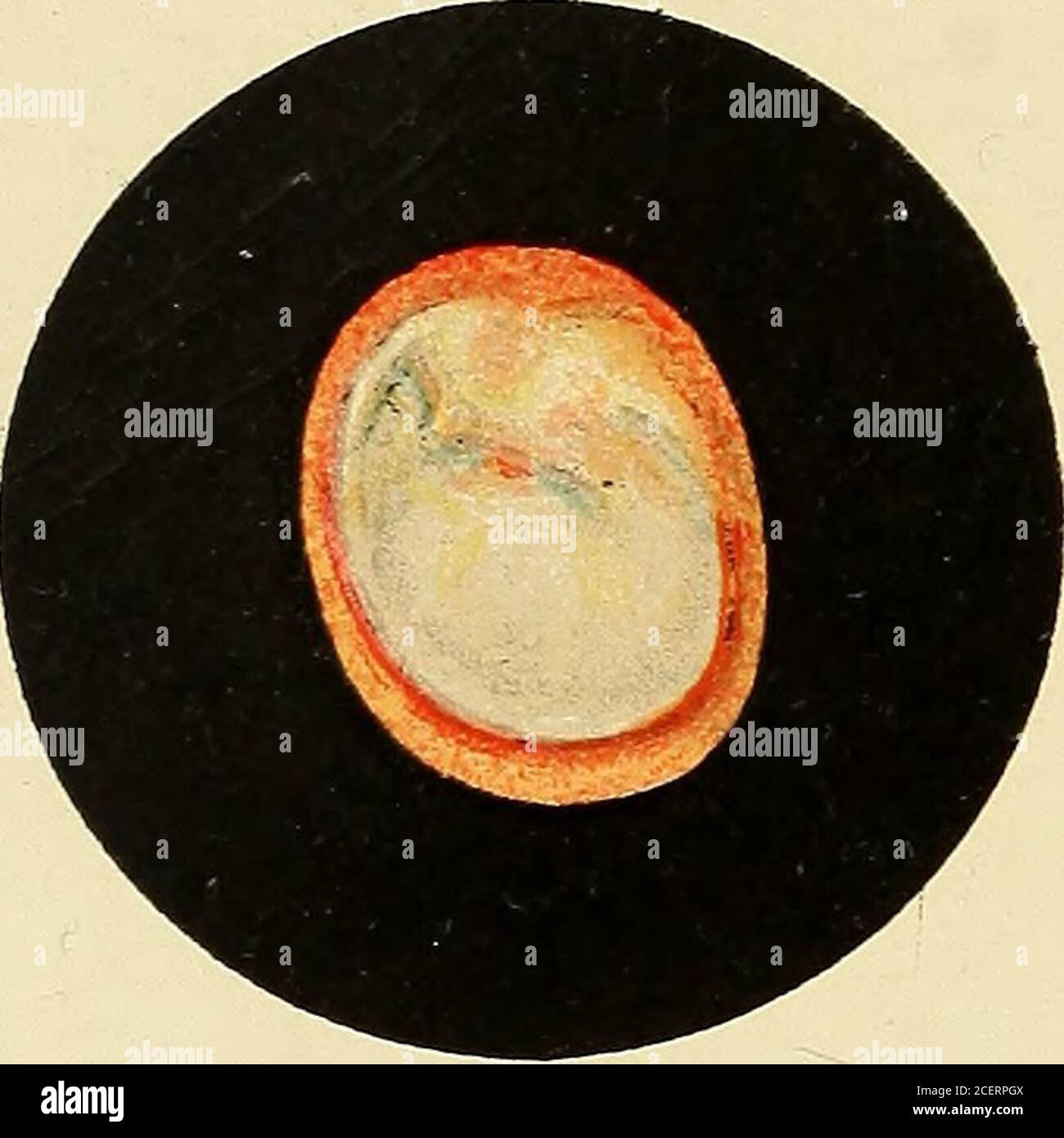 Tonsil membrane hi-res stock photography and images - Alamy