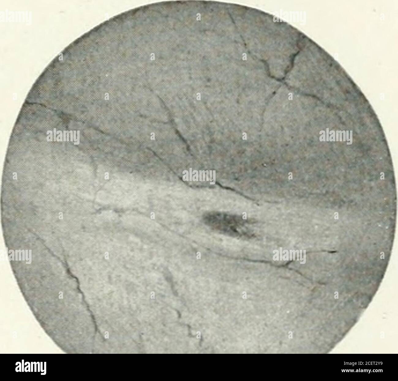 . Annals of surgery. Case VII.—Left ureter, before nephrectomy.Kidney ...