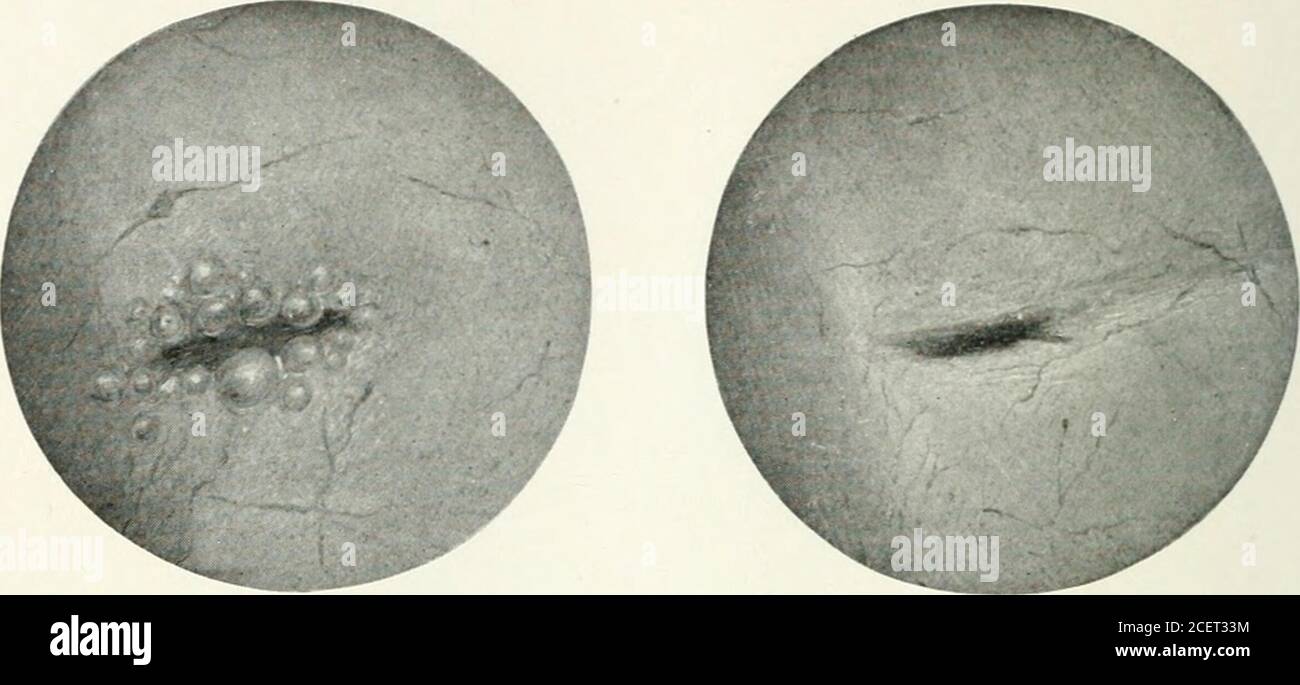 . Annals of surgery. Case VI.—Intravesical portion of prostate;nodular ...