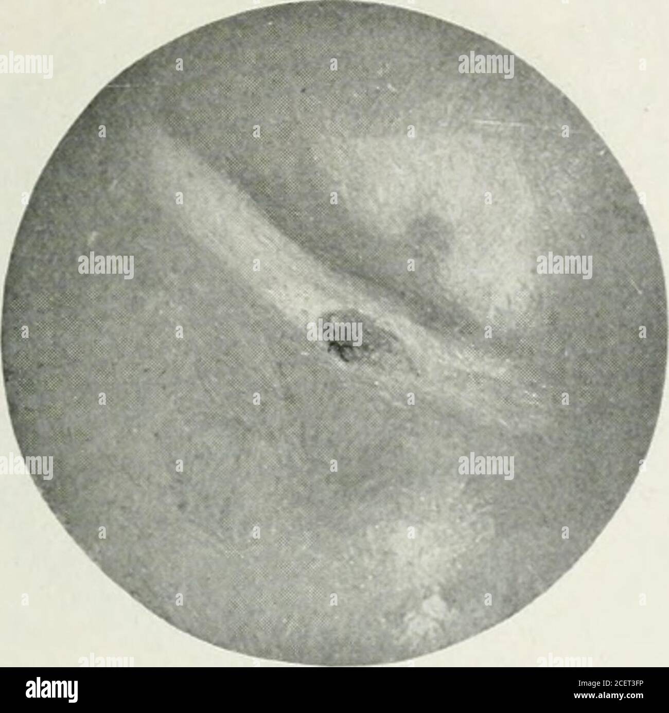 . Annals of surgery. Case IV.- - Right ureteral oriiice of ...