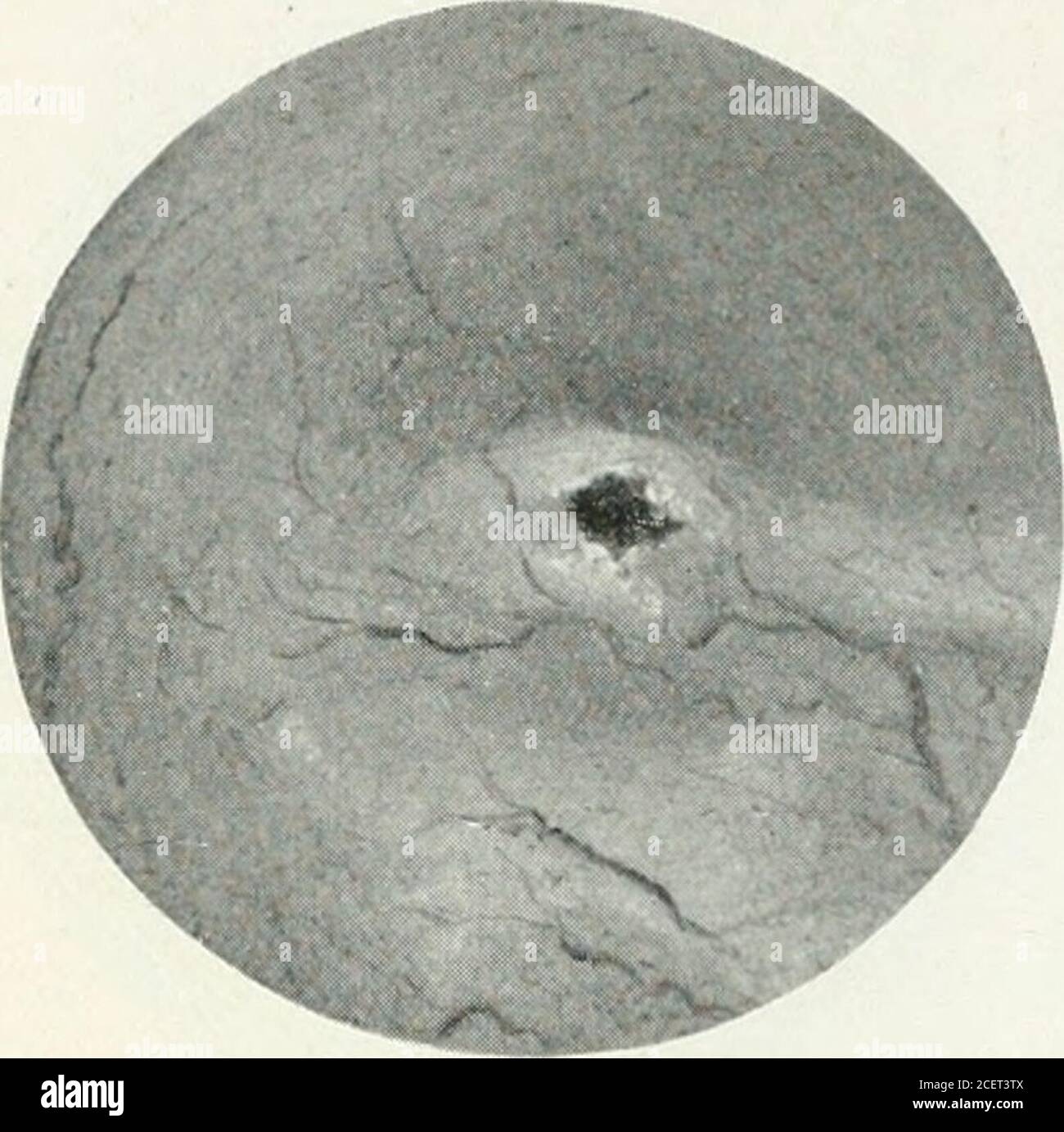 . Annals of surgery. Case II.—Right ureteral orifice. Case II.—Left ...