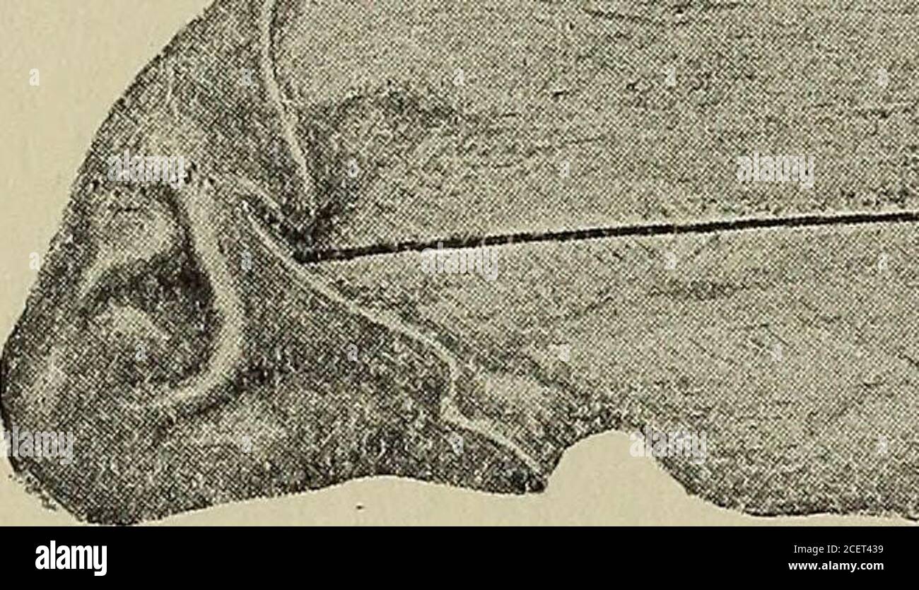 Exenteration hi-res stock photography and images - Alamy