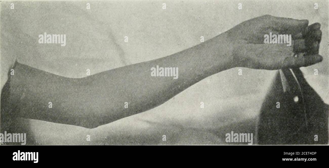 . Annals of surgery. Condition of forearm immediately previous to ...