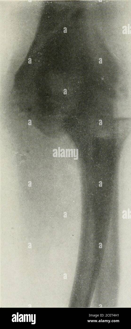 Coronoid process of ulna hi-res stock photography and images - Alamy