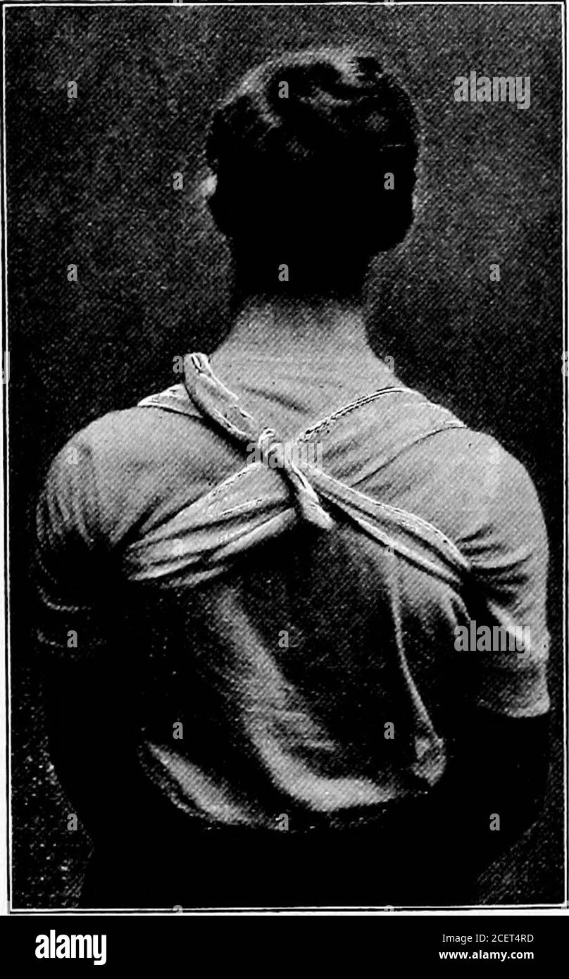 Collar bone fracture Black and White Stock Photos & Images - Alamy