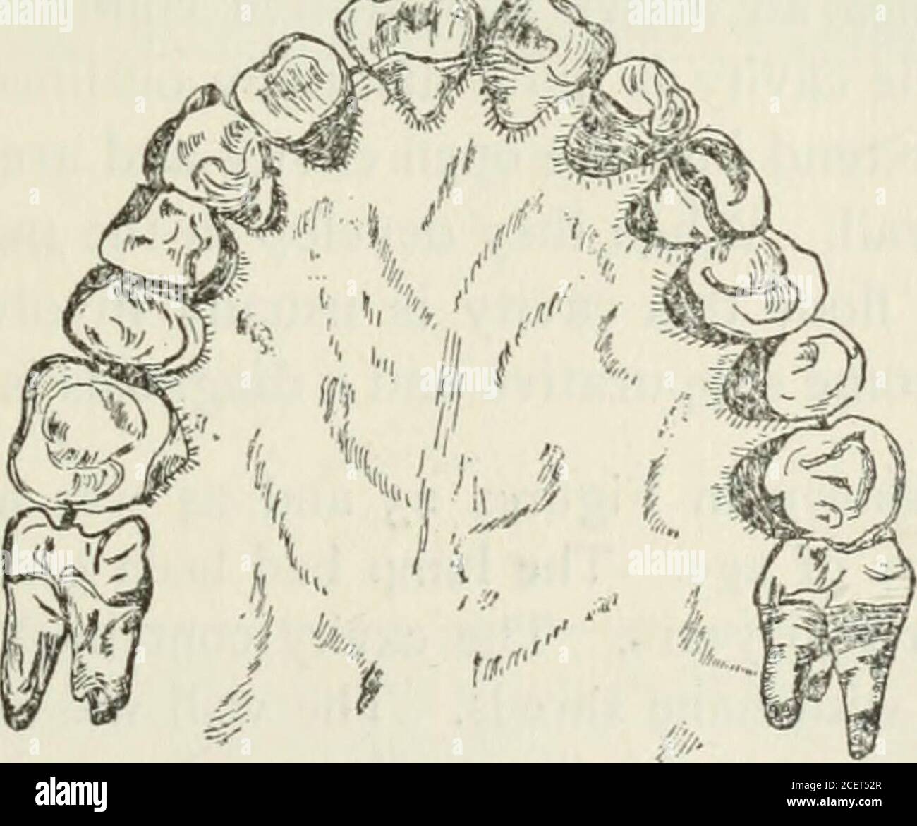 . Annals of surgery. Cyst from the roots of developed teeth. TUMORS OF ...