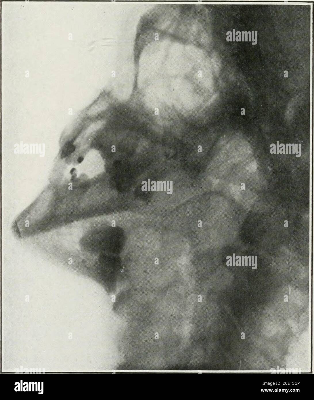 . Annals of surgery. Cyst of mandible. Cyst of mandible from two ...