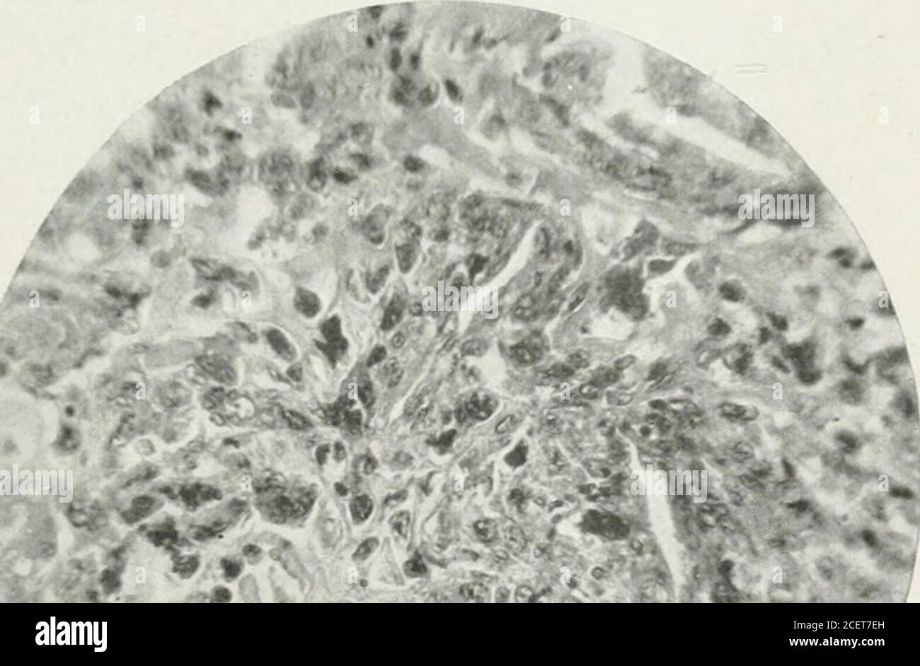 Spindle cell sarcoma hi-res stock photography and images - Alamy