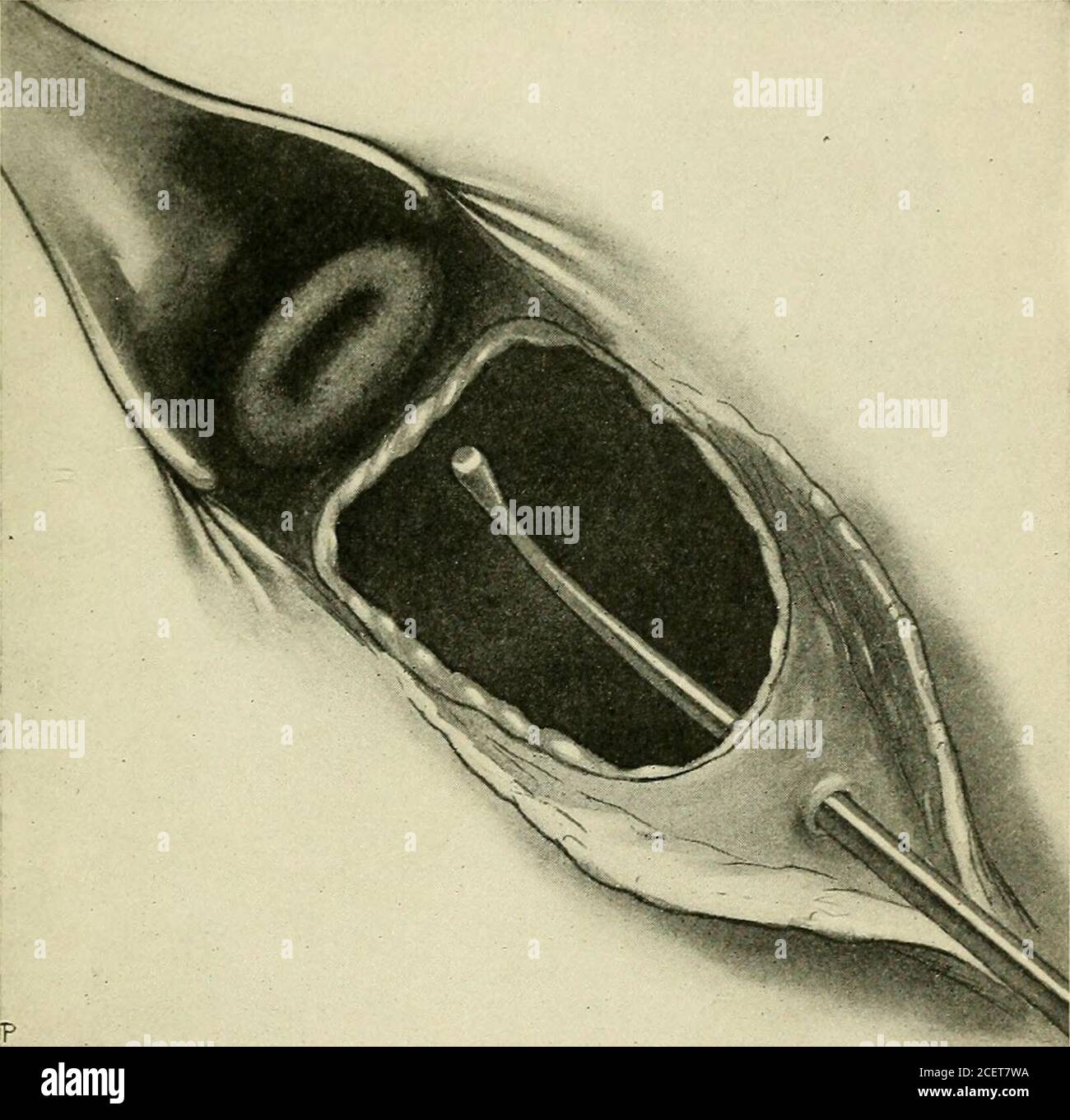 Retention sutures hi-res stock photography and images - Alamy