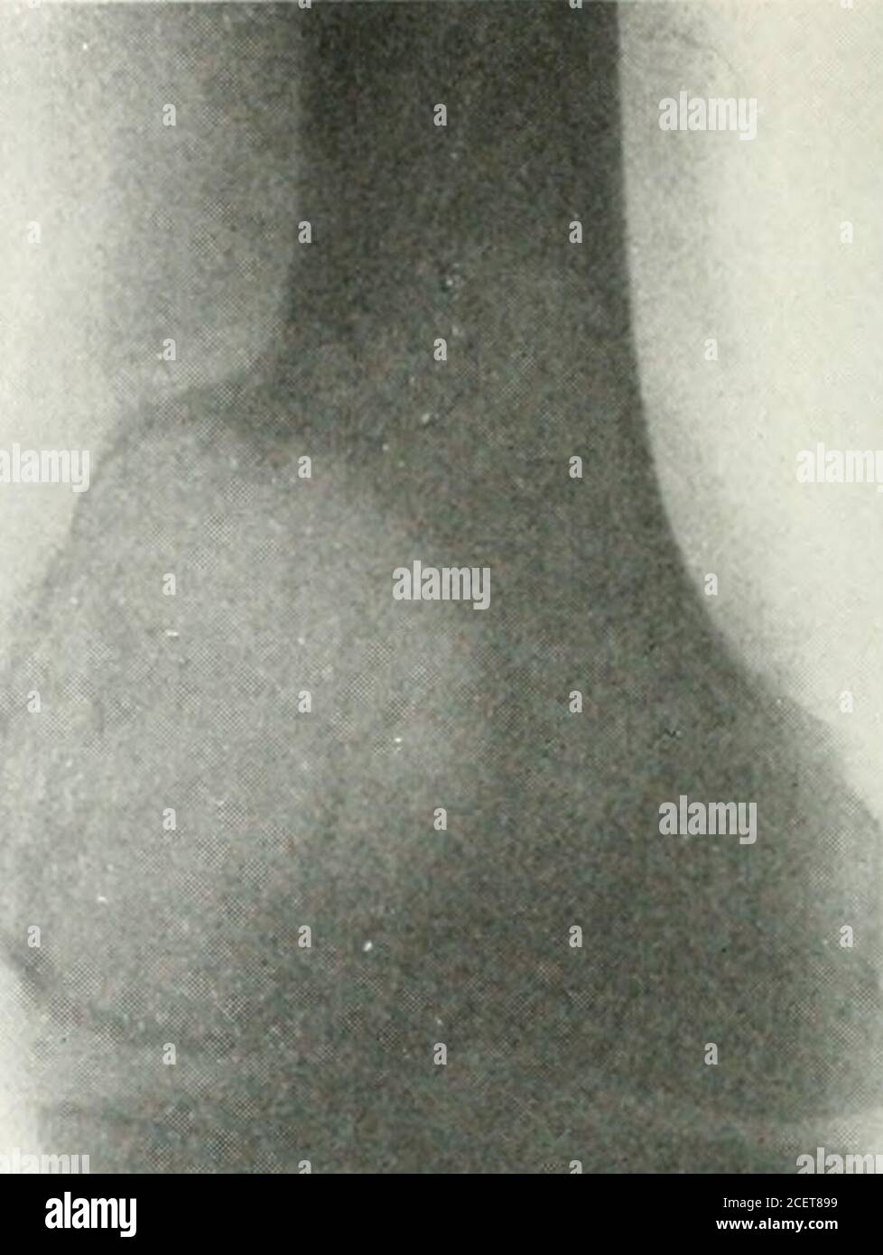 . Annals of surgery. Pathol. No. 7440. Giant-cell sar-coma. Photograph ...