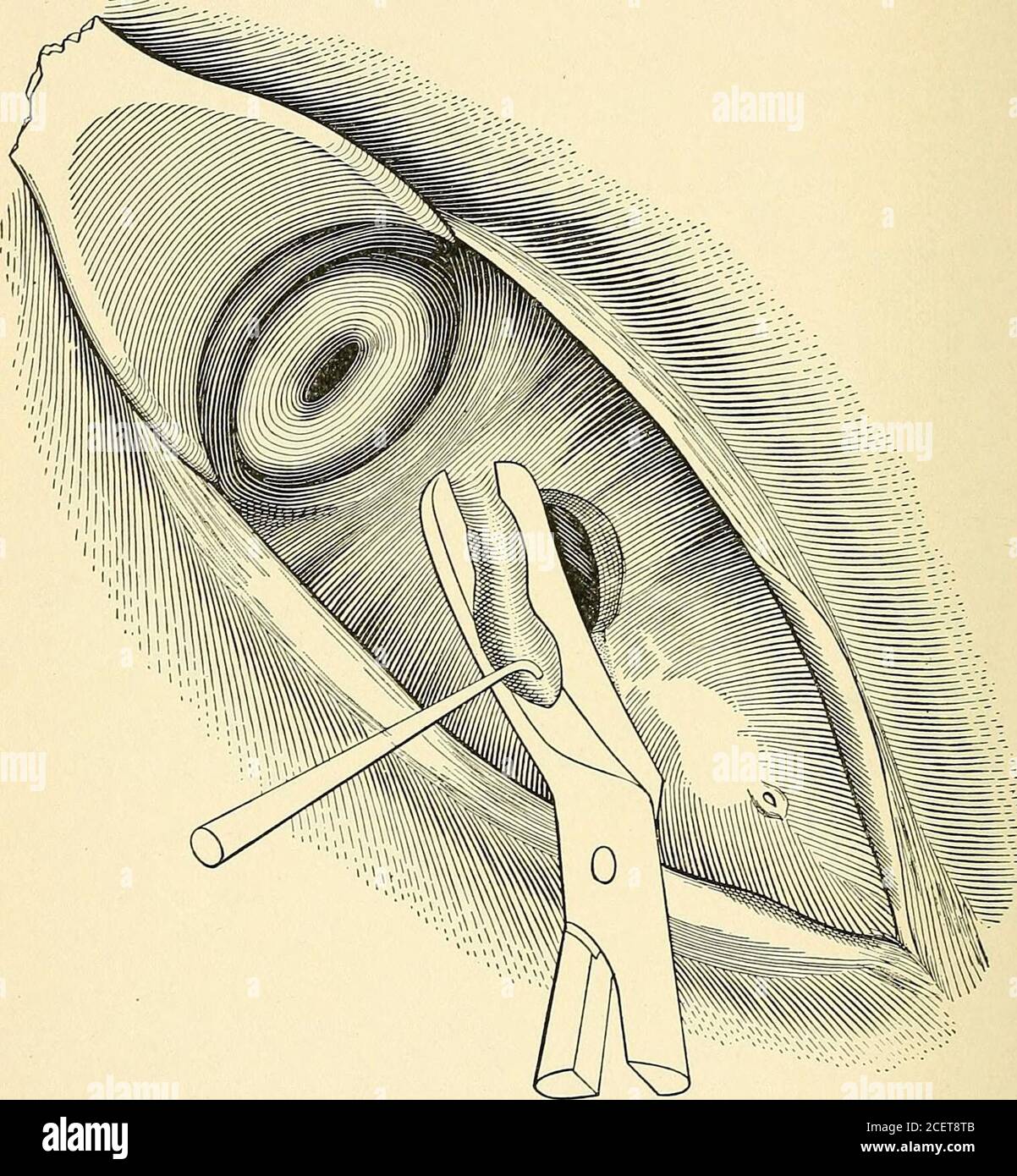Closing The Incision High Resolution Stock Photography and Images - Alamy