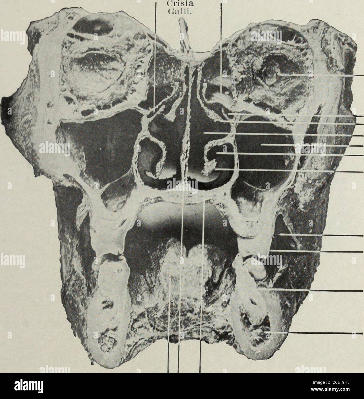 Molar inferior hi-res stock photography and images - Alamy