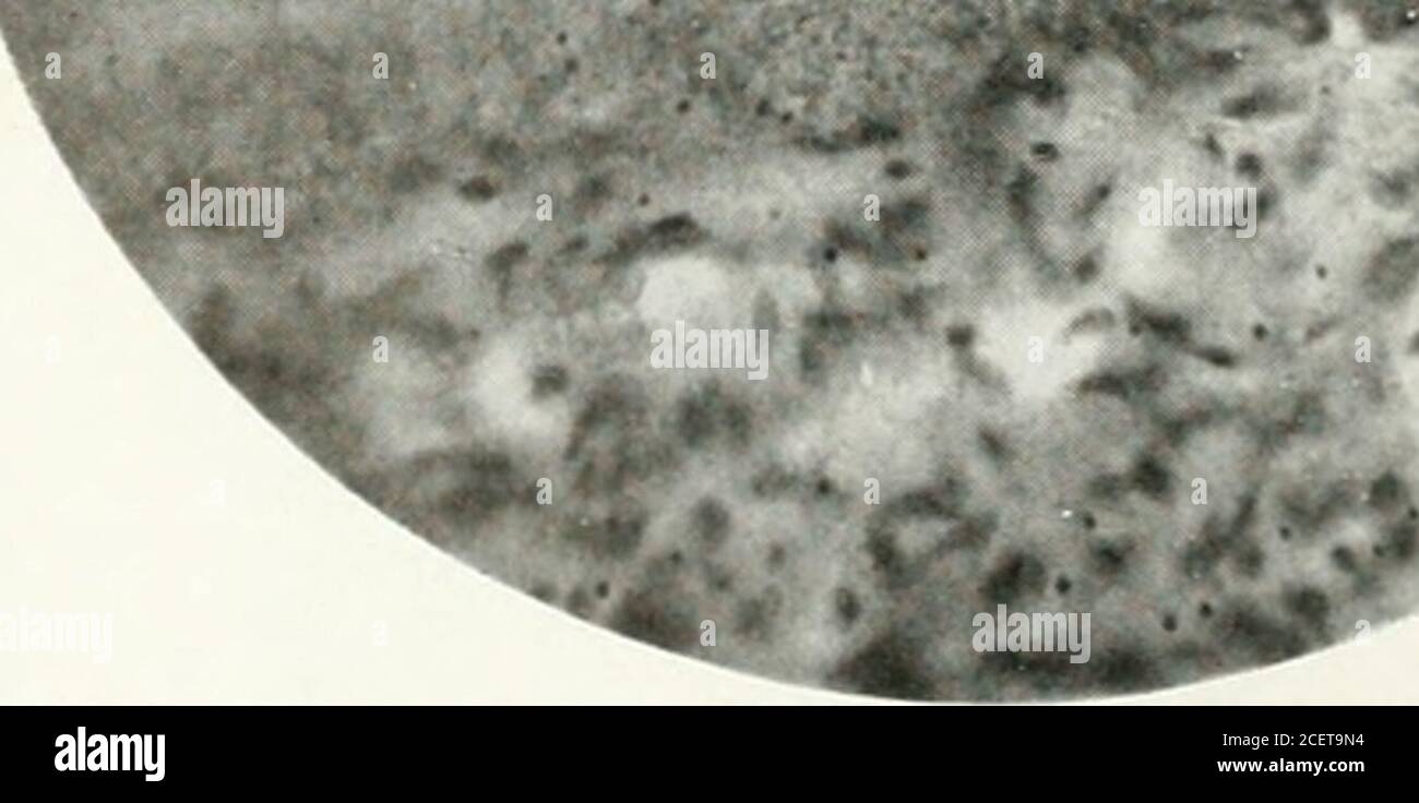 . Annals of surgery. ^ Pathol. Xo. 10352. Photomicrograph (high power ...