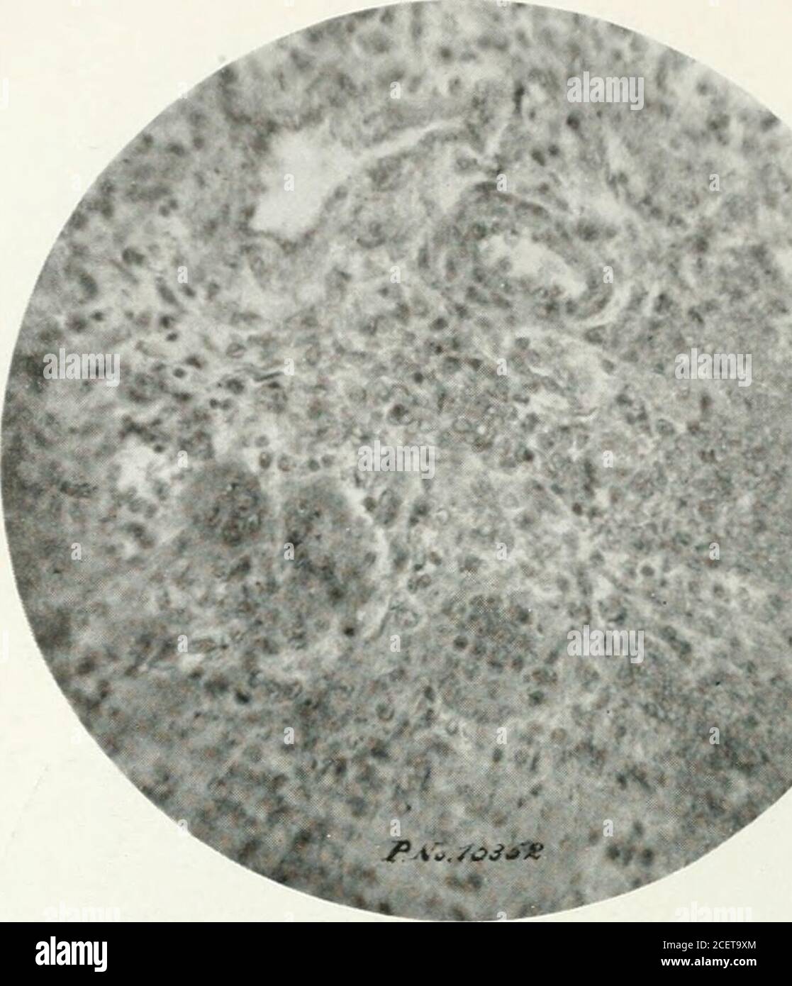 . Annals of surgery. Pathol. No. 10275. Photomicrograph by Schapiro ...