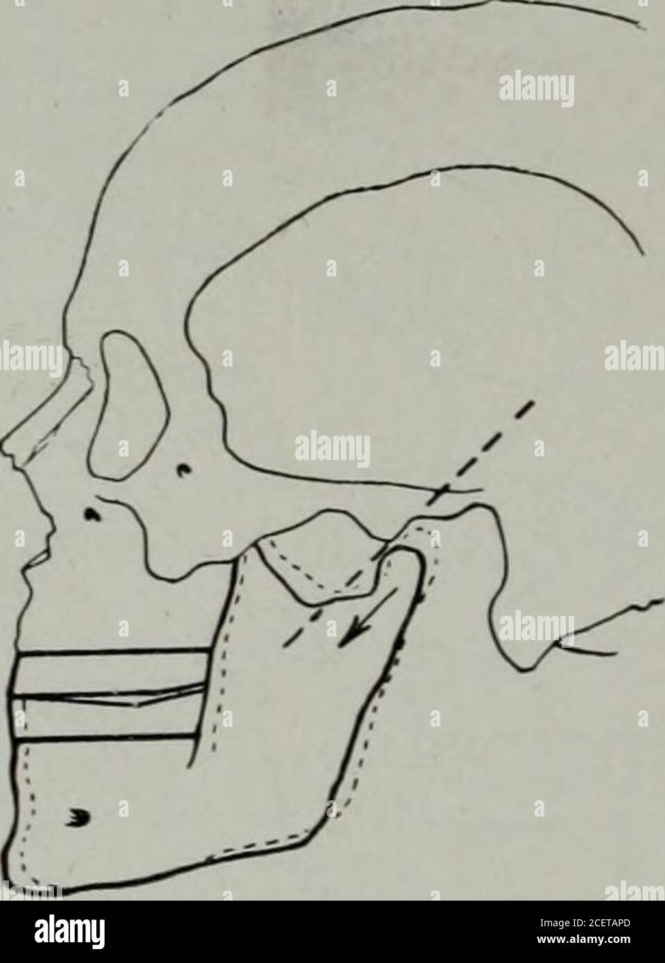 . The Dental cosmos. Worn horizontal glenoid cavity. Samecompensation ...