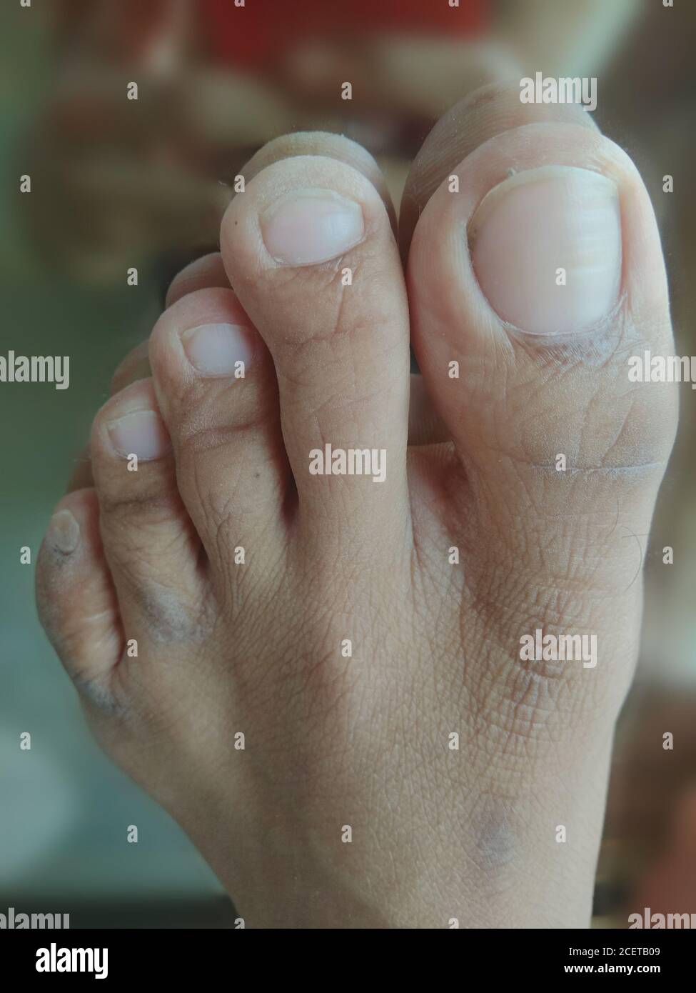 Women and therapy disease hi-res stock photography and images - Alamy