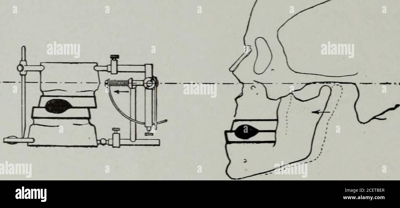 . The Dental cosmos. / / Diagram of a 45 degrees condyle path ...