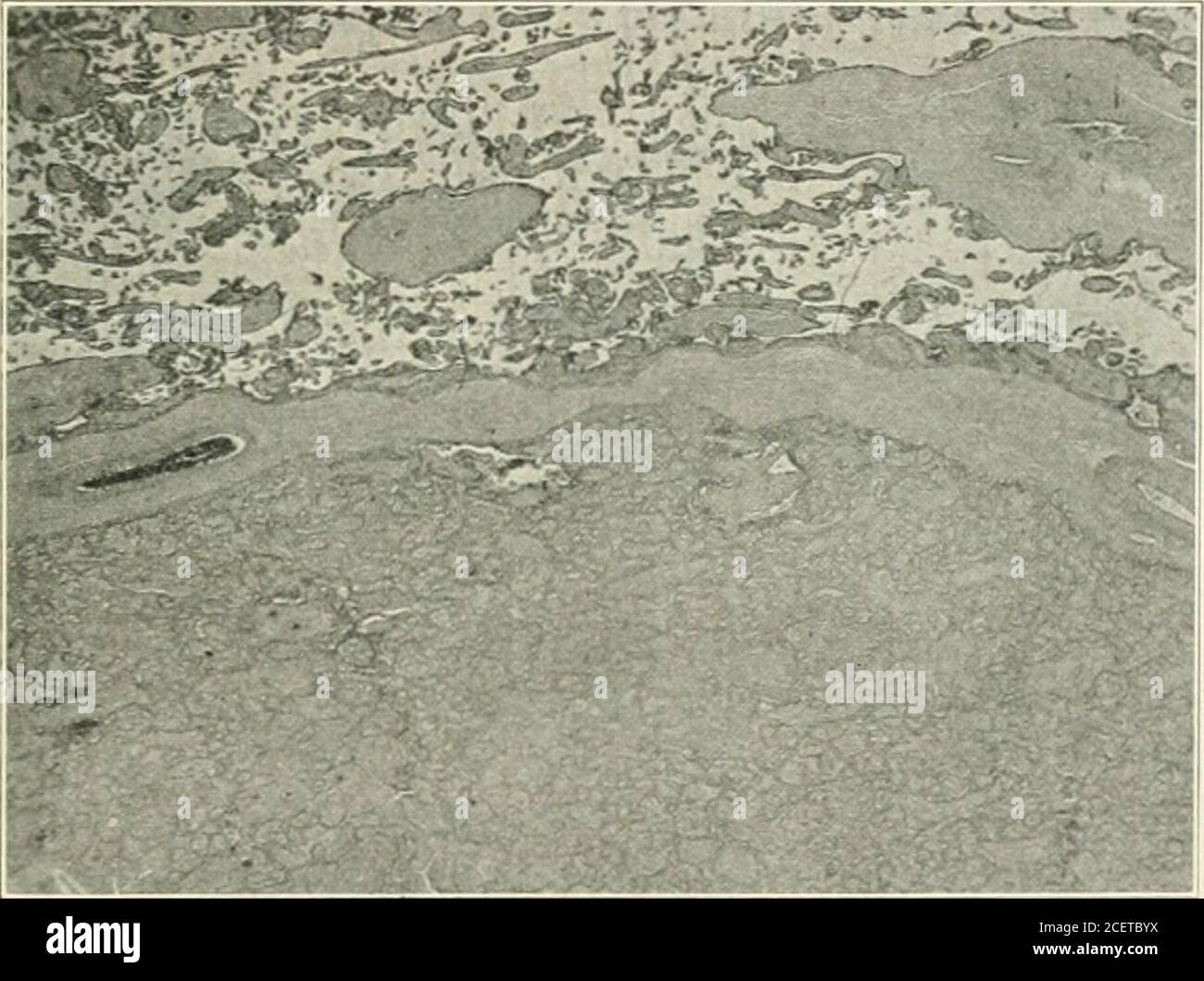 Infarcts hi-res stock photography and images - Alamy