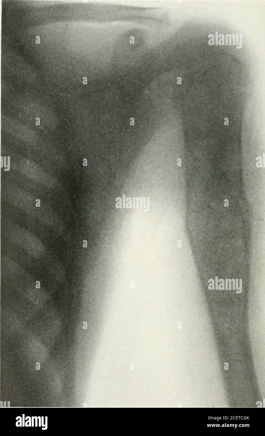 . Annals of surgery. Pathol. No. 4993. X-ray seven years after ...