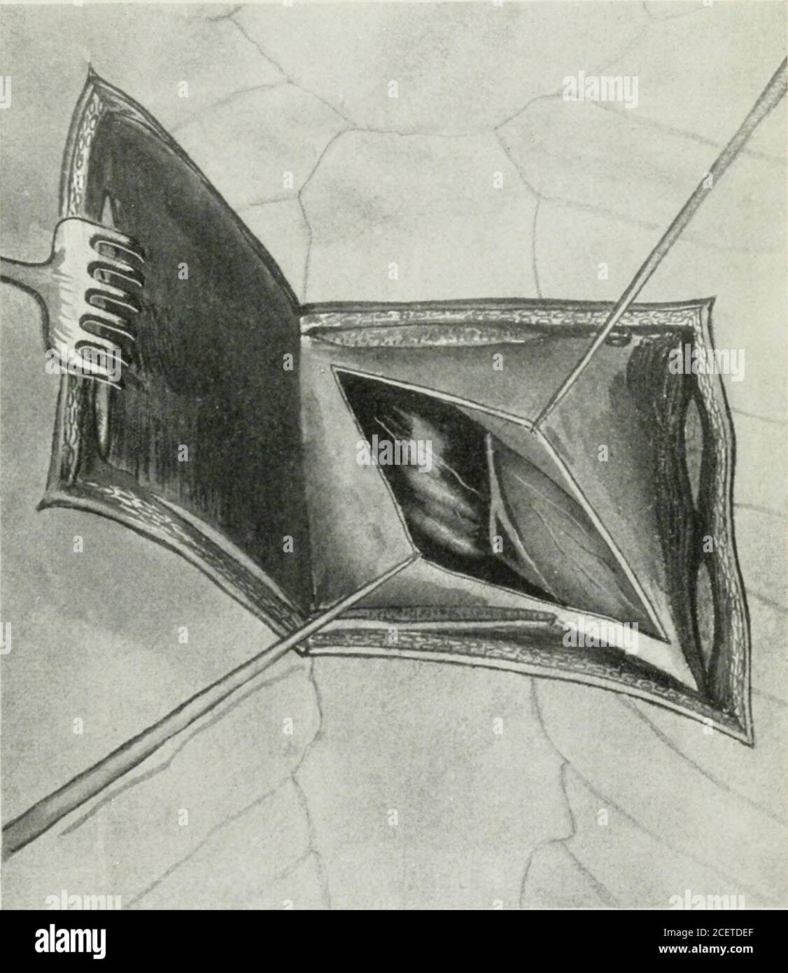 . Annals of surgery. Osteoplastic Hap made by modification of Spangaros ...